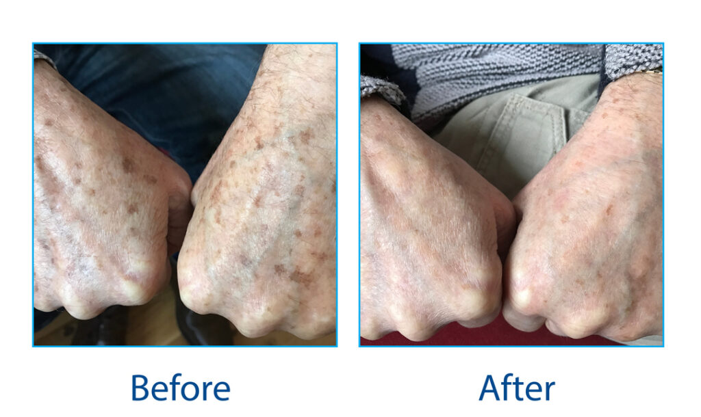 Pigment Removal - Revive Aesthetics Clinic Pigment Removal - Revive Aesthetics Clinic